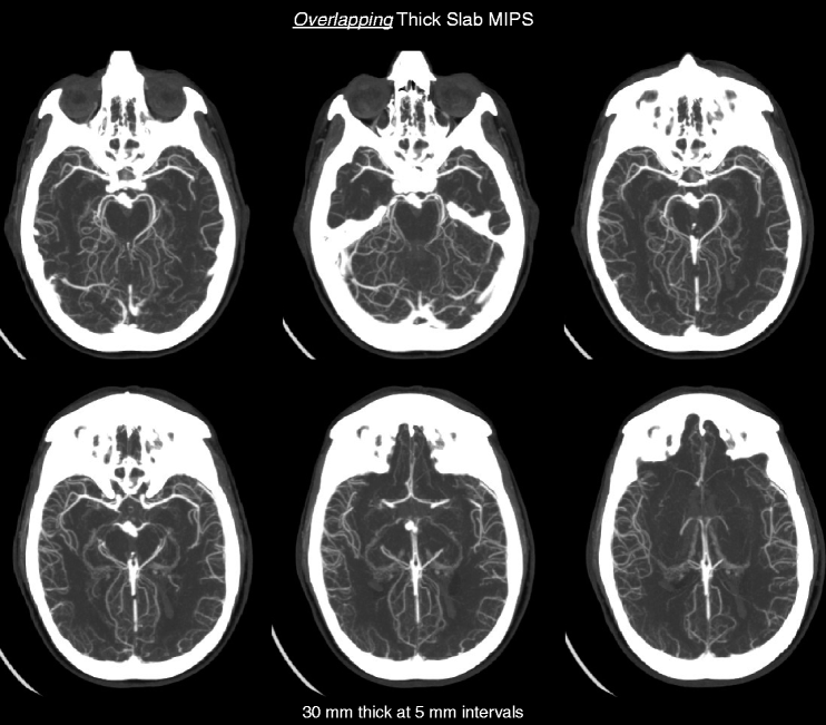 Imaging of Acute Ischemic Stroke: Stroke CT Angiography (CTA ...