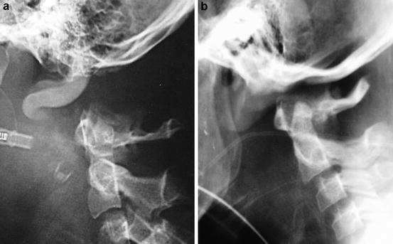 Traumatic Atlantooccipital Dislocation (AOD) | SpringerLink