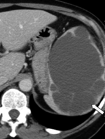 Spleen Benign and Malignant Tumors and Tumor Conditions | SpringerLink
