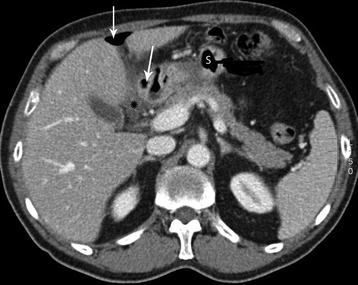 Mesentery, Omentum, Peritoneum: Embryology, Normal Anatomy and Anatomic ...