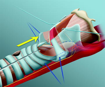 Partial Cricotracheal Resection | SpringerLink