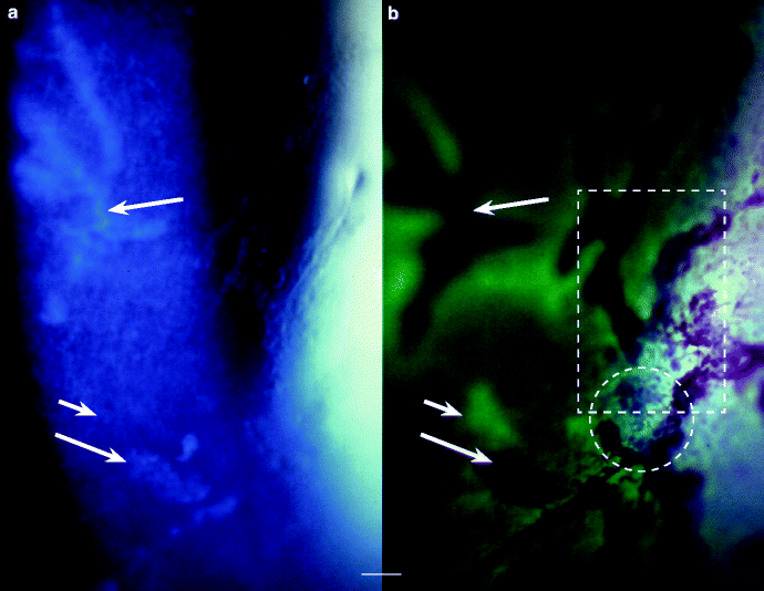 The Morphology of Varicella-Zoster Virus Epithelial Keratitis in Herpes ...
