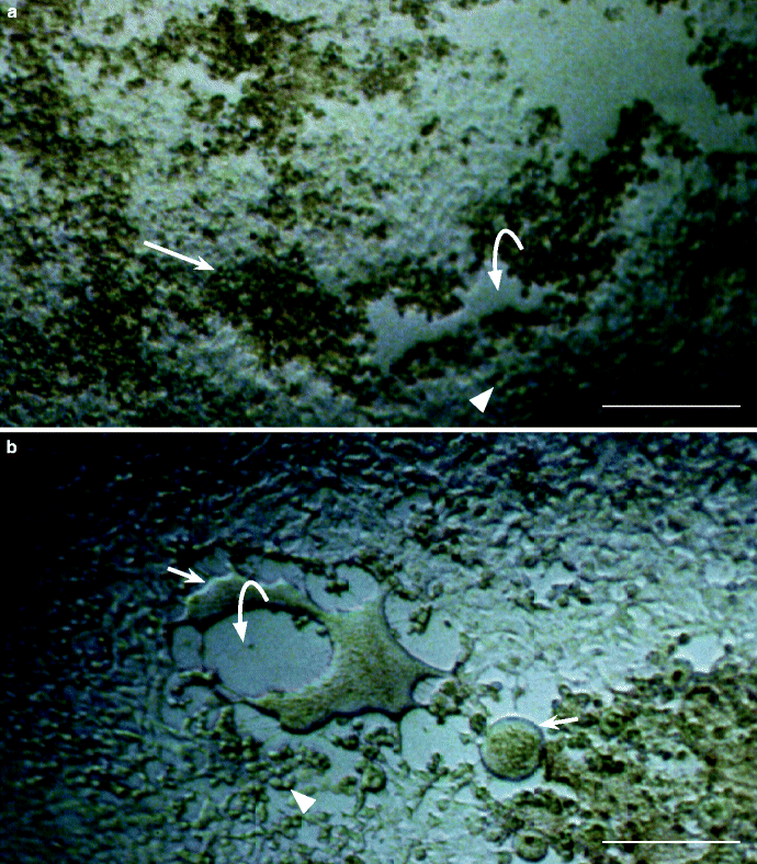 The Morphology of Varicella-Zoster Virus Epithelial Keratitis in Herpes ...