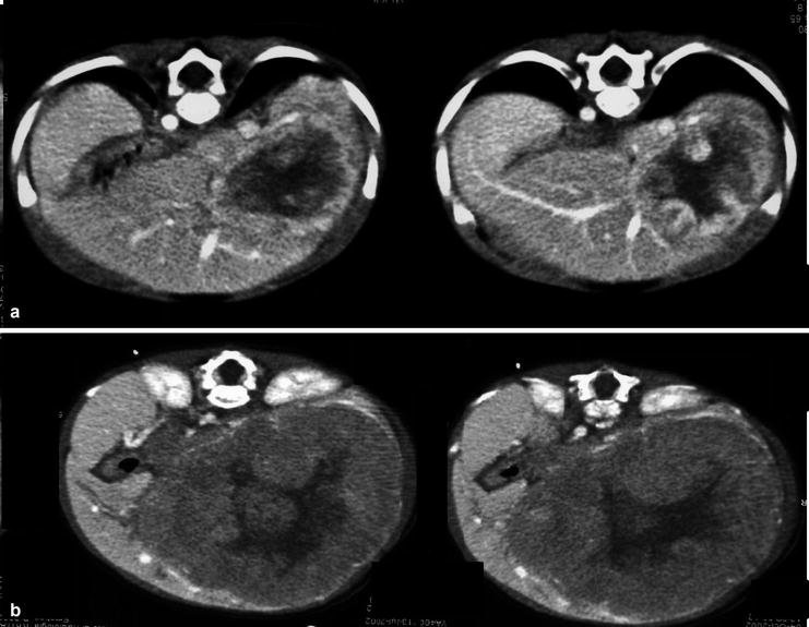 Chemotherapy for Childhood Hepatoblastoma and Hepatocellular Carcinoma ...
