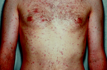 Early and Late Syphilis | SpringerLink