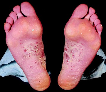 Early and Late Syphilis | SpringerLink