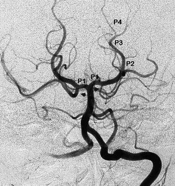 Posterior Cerebral Artery | SpringerLink