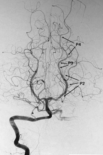 Posterior Cerebral Artery | SpringerLink
