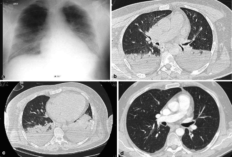 Leukostasis, Infiltration and Pulmonary Lysis Syndrome Are the Three ...