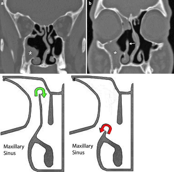 Imaging the Paranasal Sinuses and Nasal Cavity After Surgery | SpringerLink