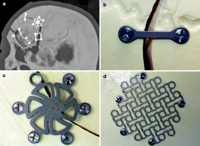Imaging the Postoperative Scalp and Cranium | SpringerLink