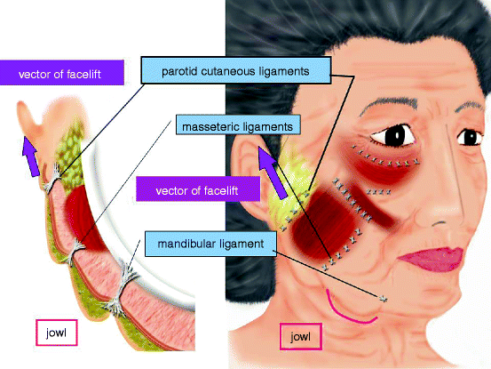 Suspension of the Retaining Ligaments and Platysma in Facelift: From ...
