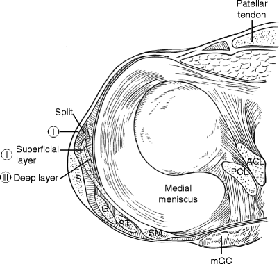 Medial Collateral Ligament (MCL) | SpringerLink