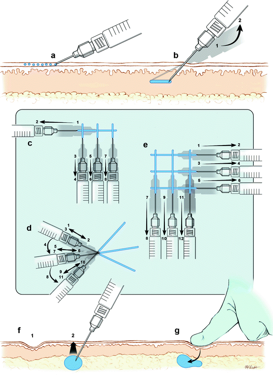 Augmentation with Injectable Fillers | SpringerLink