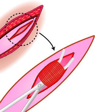 A10 Subcostal and Rooftop Incisions | SpringerLink
