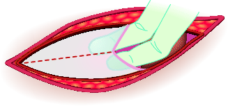 A10 Subcostal and Rooftop Incisions | SpringerLink