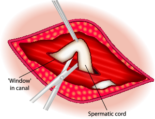 F2 Inguinal Hernia and Ligation of Patent Processus Vaginalis ...