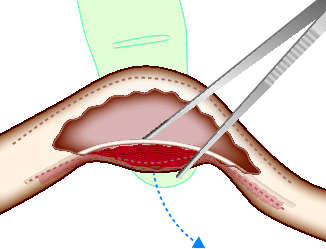 F2 Inguinal Hernia and Ligation of Patent Processus Vaginalis ...