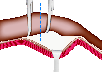 F2 Inguinal Hernia and Ligation of Patent Processus Vaginalis ...
