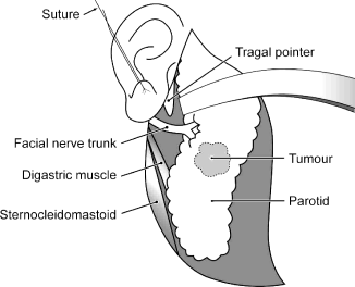 B7 Parotid Dissection | SpringerLink