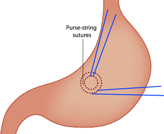E6 Stamm Gastrostomy | SpringerLink