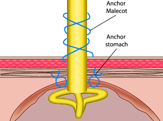 E6 Stamm Gastrostomy | SpringerLink