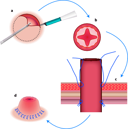 E16 Subtotal Colectomy and Ileostomy | SpringerLink