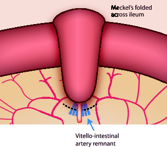 E20 Meckel’s Diverticulum and other Vitello-intestinal Anomalies ...