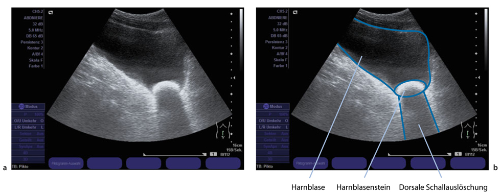 Gutartige Veränderungen von Harnleiter und Blase | SpringerLink