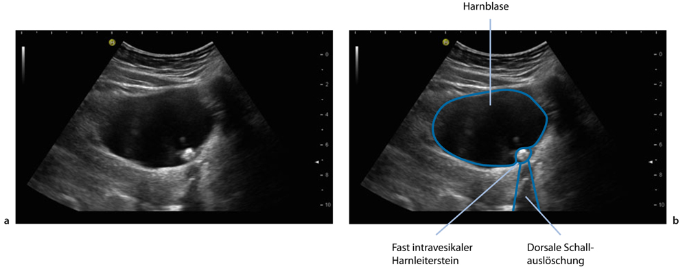 Gutartige Veränderungen von Harnleiter und Blase | SpringerLink