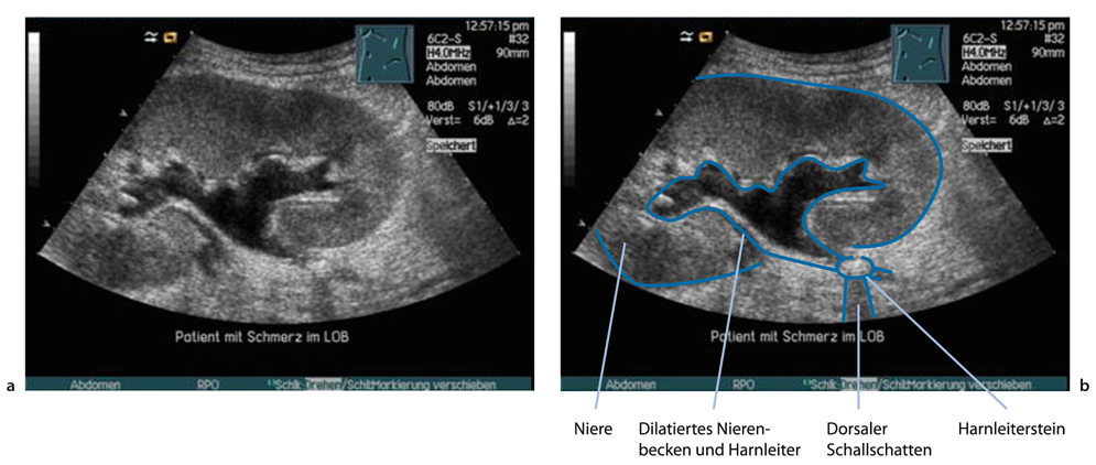 Gutartige Veränderungen von Harnleiter und Blase | SpringerLink