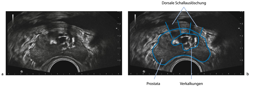 Gutartige Veränderungen von Prostata und Samenblasen | SpringerLink