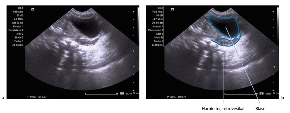 Kinderurologische Krankheitsbilder | SpringerLink