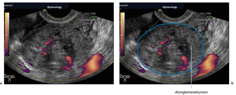 Gynäkologischer Ultraschall | SpringerLink
