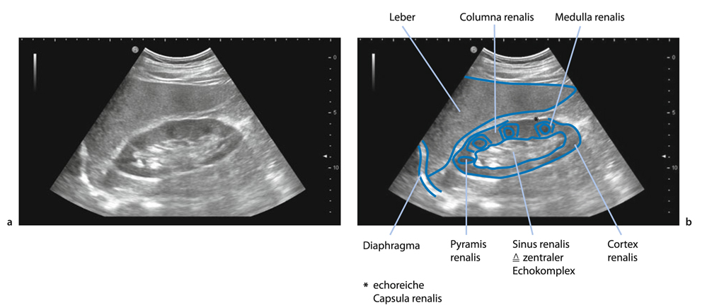 Normalbefunde und Normvarianten der Niere | SpringerLink