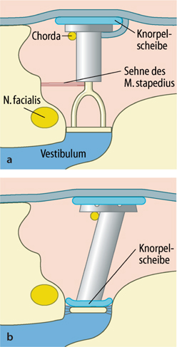 Klinik des Mittelohres | SpringerLink