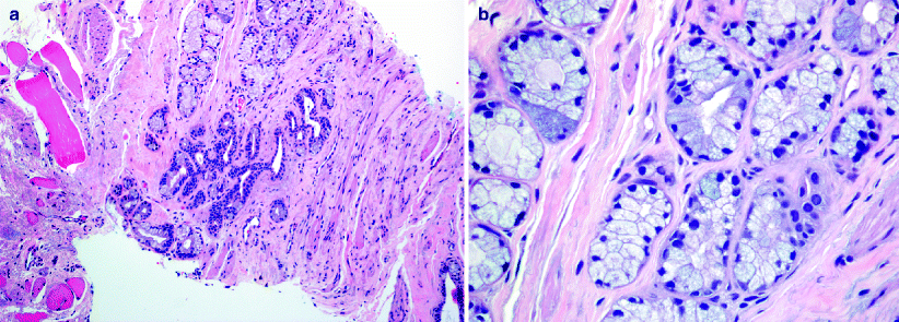 Anatomy and Normal Histology of the Prostate Pertinent to Biopsy ...