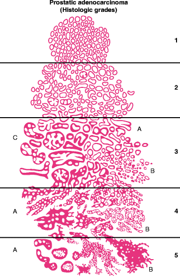 Contemporary Approach to Gleason Grading of Prostate Cancer | SpringerLink
