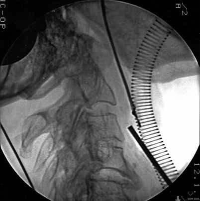 Anterior Transarticular Screw Fixation C1/C2 | SpringerLink