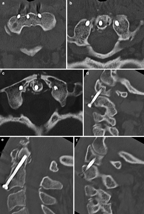 Anterior Transarticular Screw Fixation C1/C2 | SpringerLink