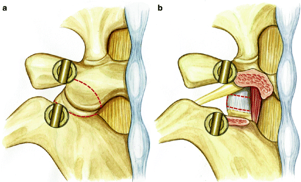 Transforaminal Lumbar Interbody Fusion | SpringerLink