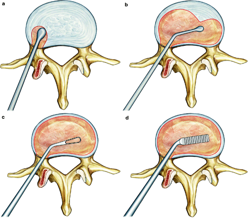 Transforaminal Lumbar Interbody Fusion | SpringerLink