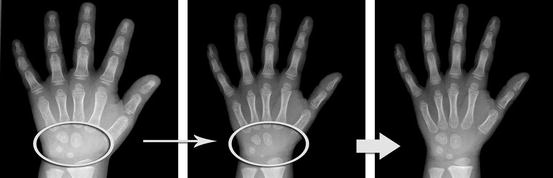 Digital Bone Age Atlas | SpringerLink