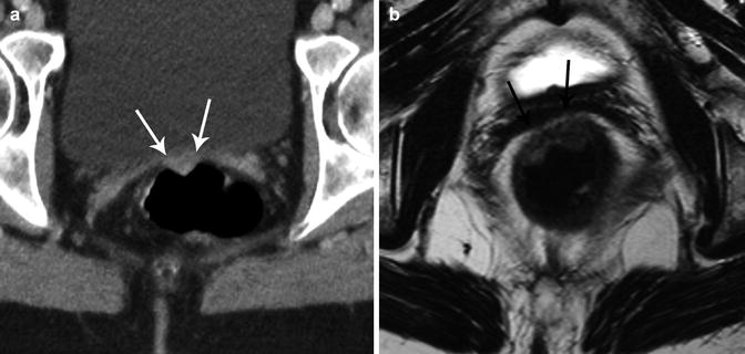 How Can We Identify Mesorectal Fascia Involvement? | SpringerLink