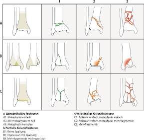 Distaler Unterschenkel (Pilon tibial) | SpringerLink