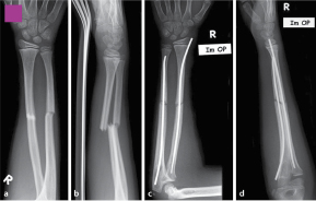 Unterarmschaft | SpringerLink