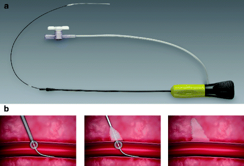 Closure of Percutaneous Vascular Access | SpringerLink