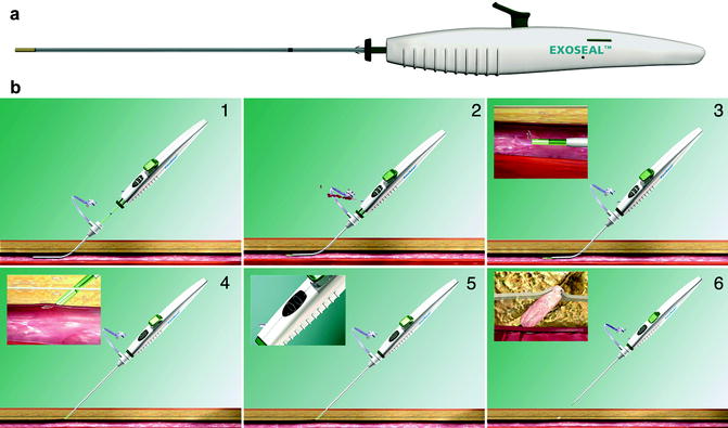 Closure of Percutaneous Vascular Access | SpringerLink