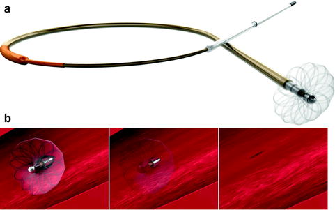 Closure of Percutaneous Vascular Access | SpringerLink
