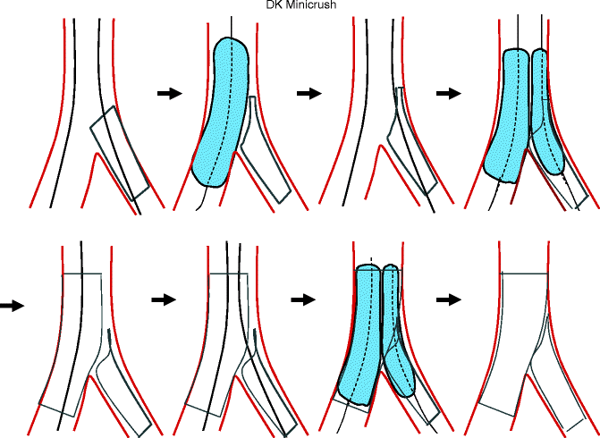 Treatment of Coronary Artery Bifurcation Lesions | SpringerLink